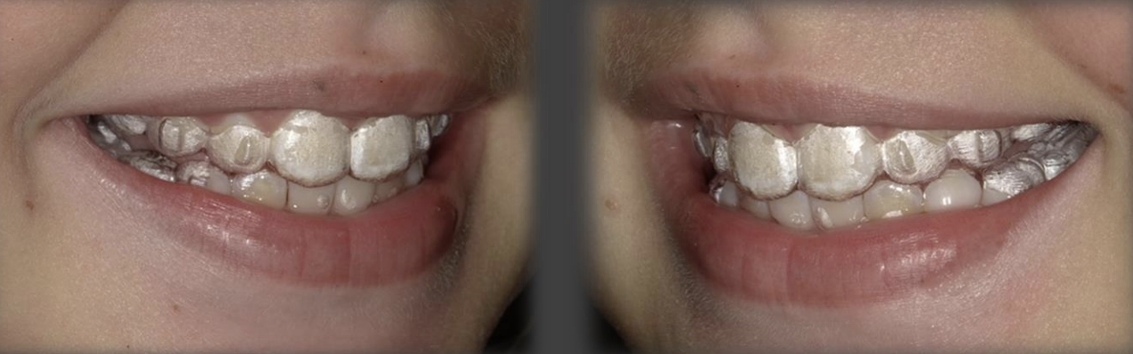 Chronically Enlarged Tonsils | What Does this Mean for Dentists?