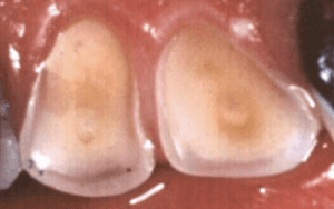 Pitting and Erosive Tooth Lesions: What Does It Mean?