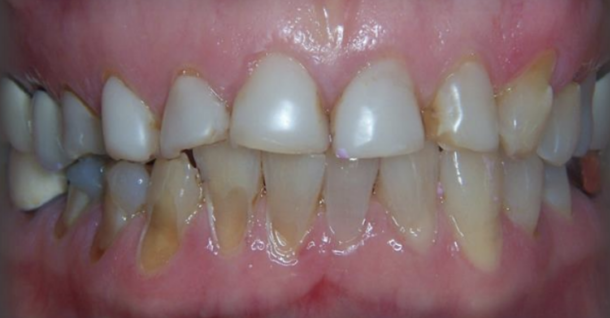 Pitting and Erosive Tooth Lesions: What Does It Mean?