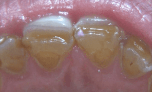 Pitting and Erosive Tooth Lesions: What Does It Mean?