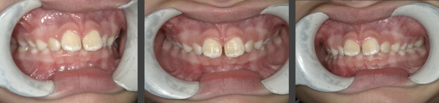 Chronically Enlarged Tonsils | What Does this Mean for Dentists?