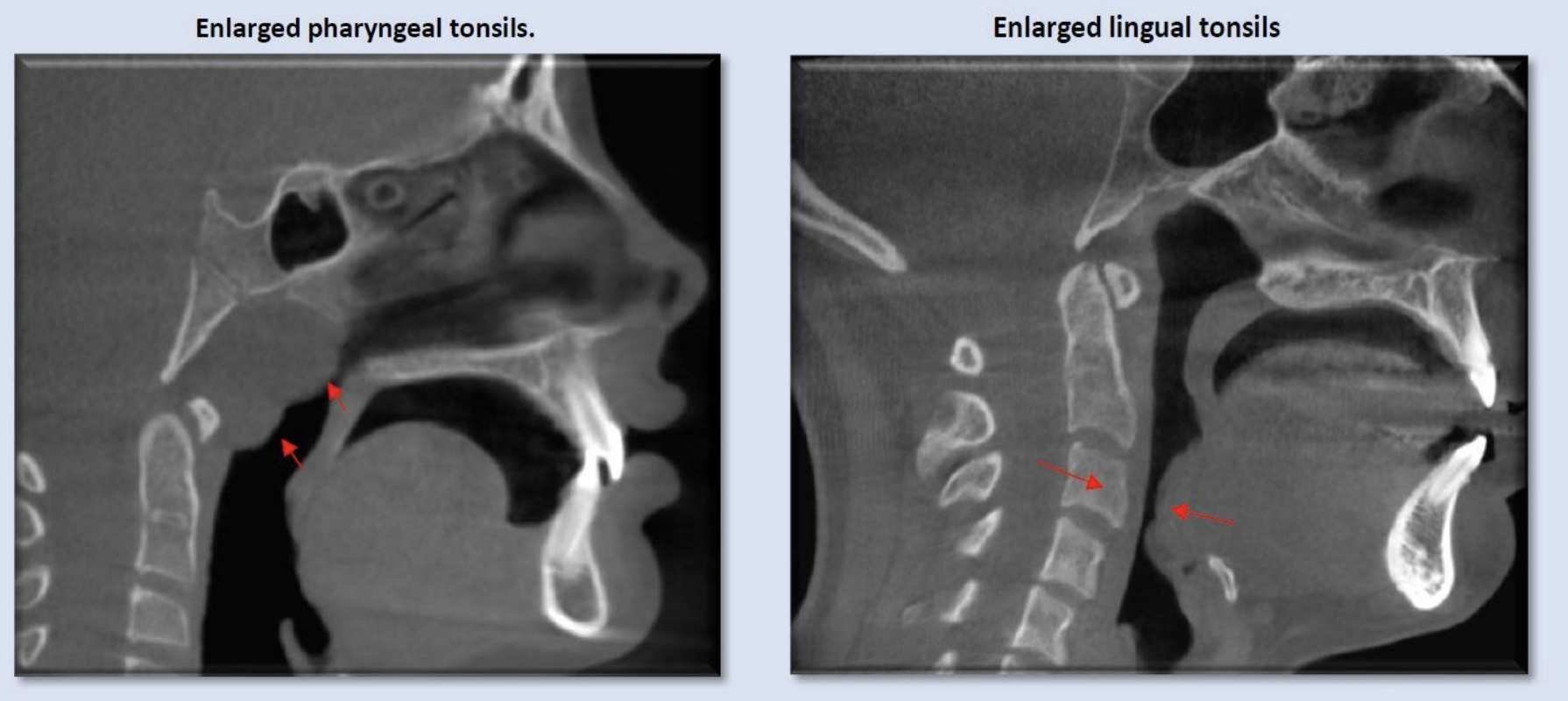 Chronically Enlarged Tonsils | What Does this Mean for Dentists?
