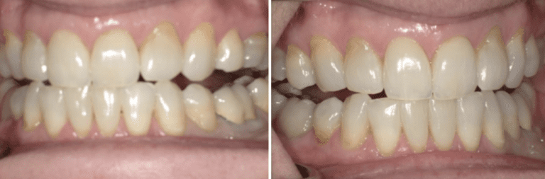 Posterior Open Bites: Case Study | IGNITEDDS