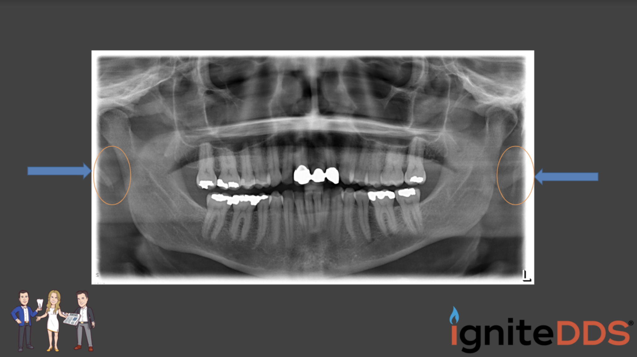 Stylohyoid Calcification: Case Study | IGNITEDDS