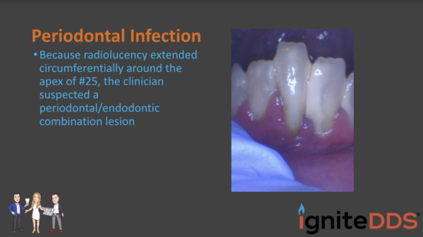 Periodontal Infection: Case Study | IGNITEDDS