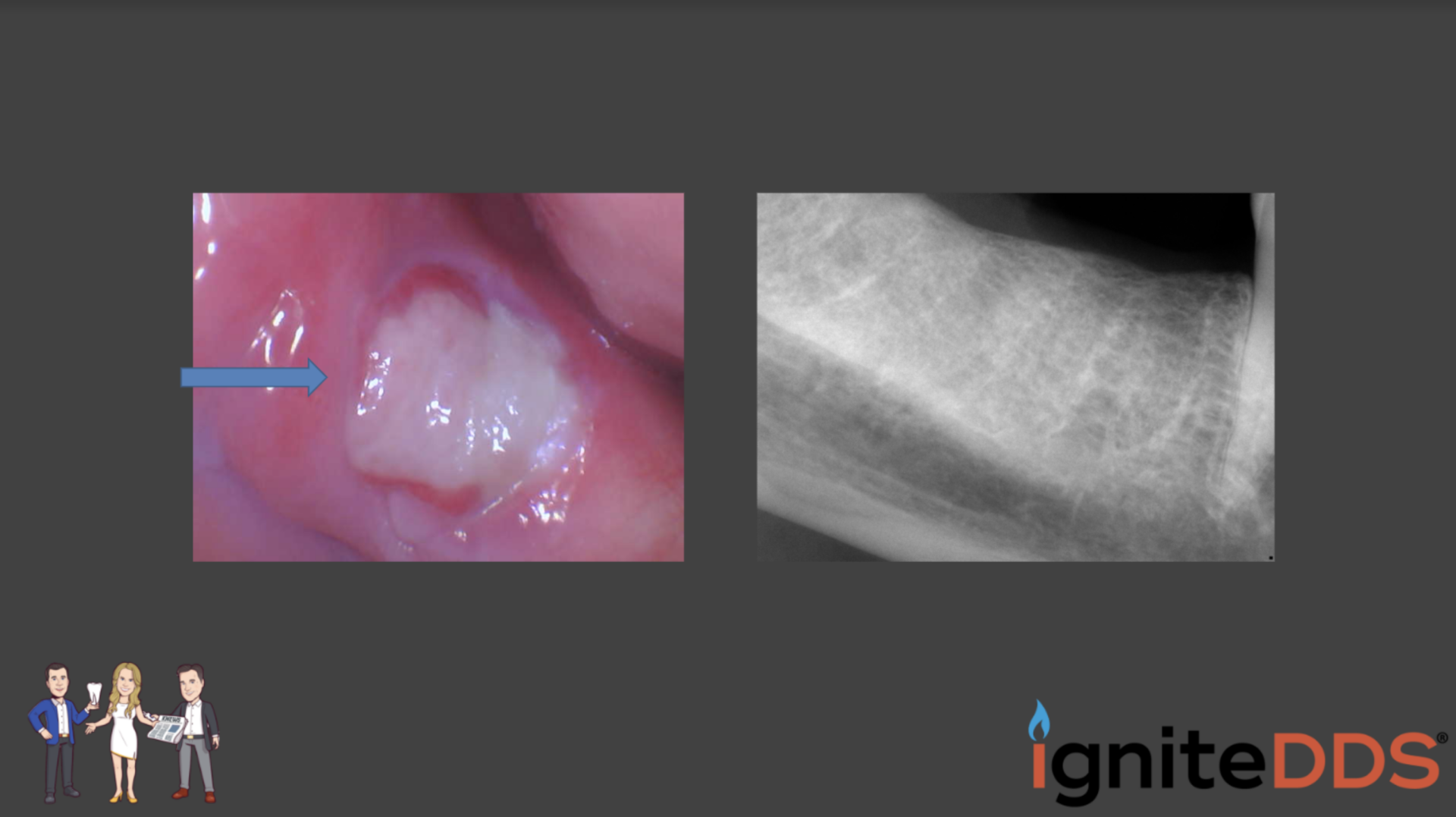 Spontaneous Bone Spurs: Case Study | IGNITEDDS