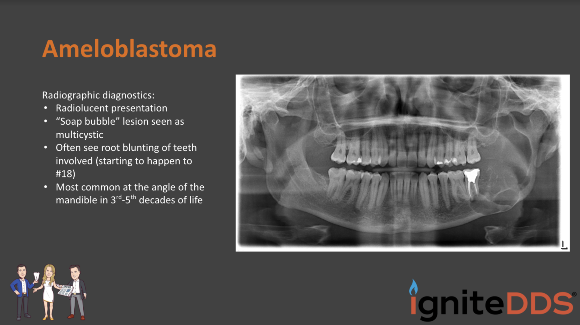 Ameloblastoma: Case Study | IGNITEDDS