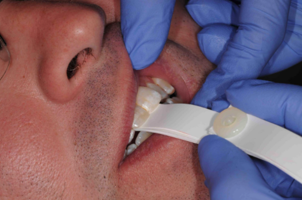 When Your Occlusal Clearance Disappears: IGNITEDDS