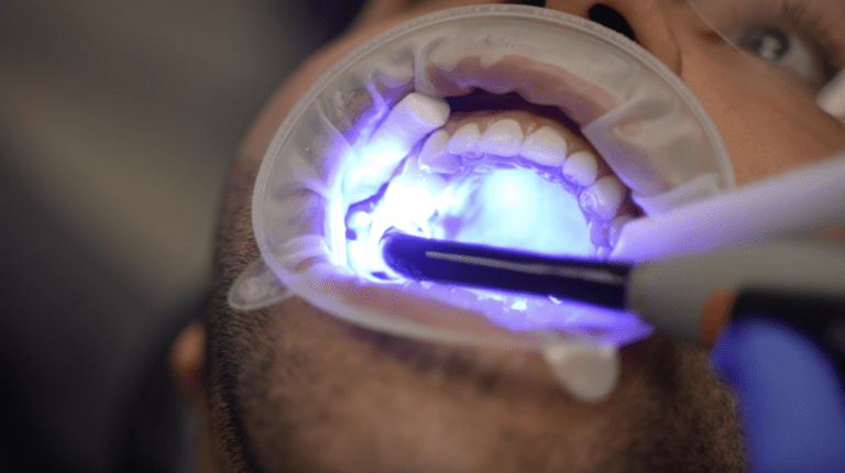 Unlocking Precision and Comfort: The Optragate by Ivoclar