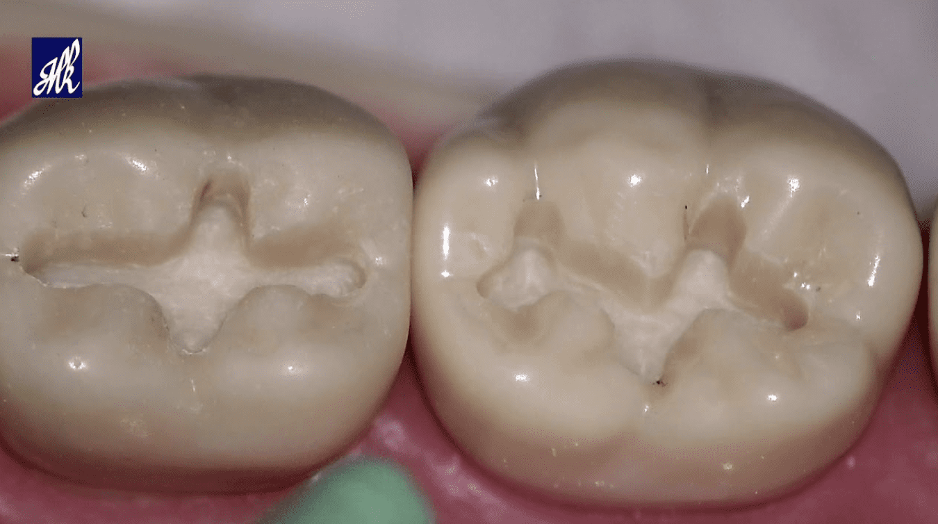 Class I Preparation and Restoration: Guide for D1 Students