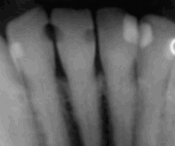 Class III Preparation Restoration: Guide for Dental Students