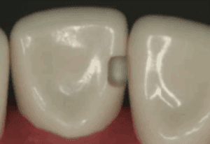Class III Preparation Restoration: Guide for Dental Students