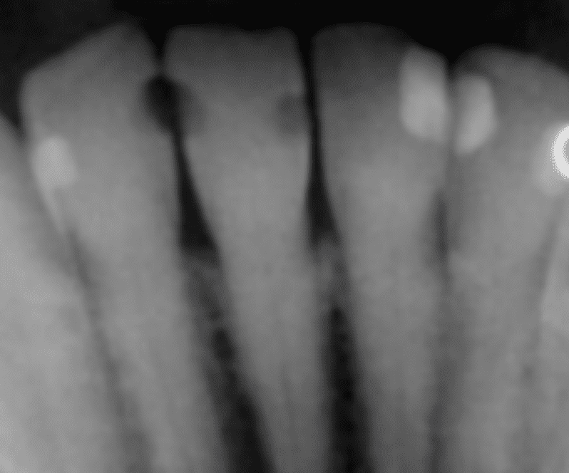 Class III Preparation Restoration: Guide for Dental Students