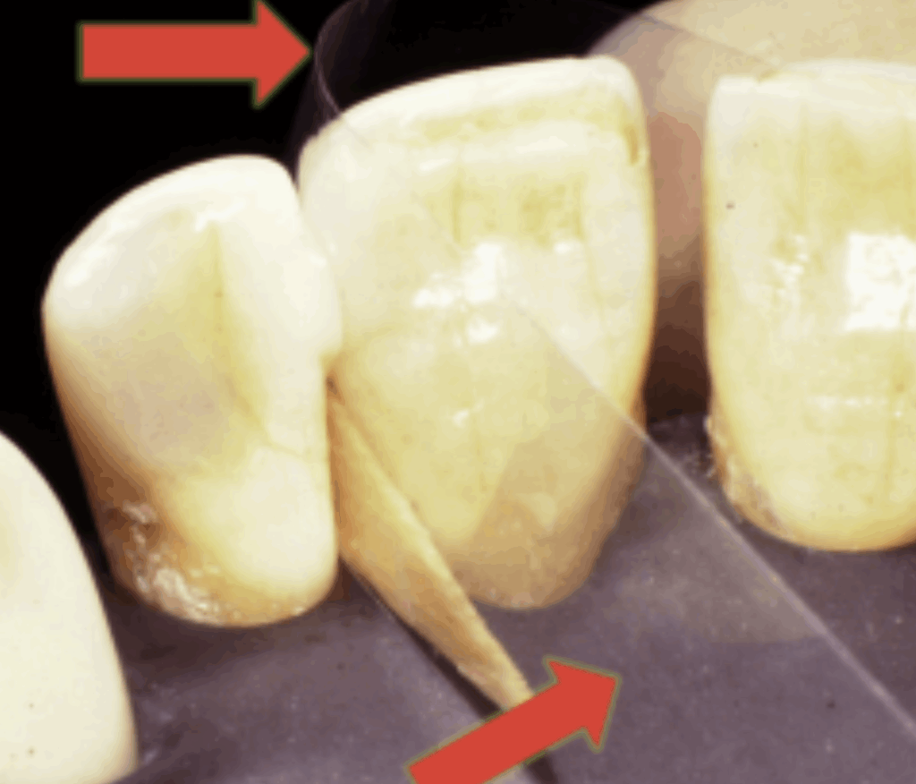 Class III Preparation Restoration: Guide for Dental Students